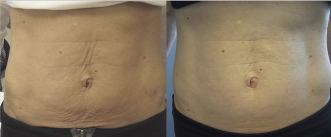 Sciton SkinTyte, BBL, Laser Skin Rejuvenation Treatment NYC