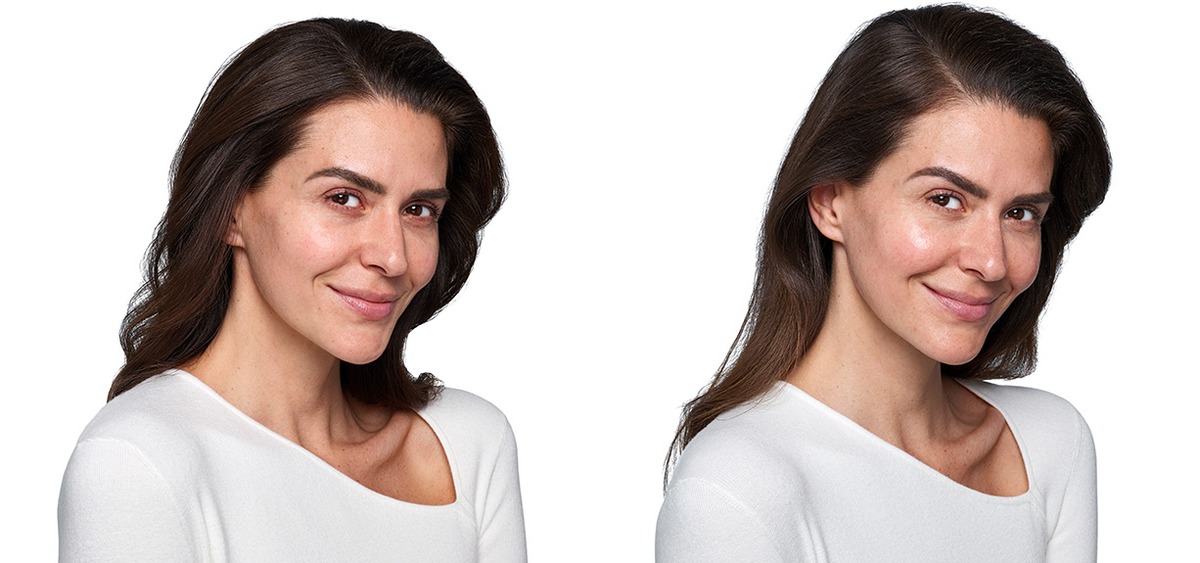 Skinvive by Juvéderm for Cheek Area, Skinvive by Juvederm - Dr. Michele ...