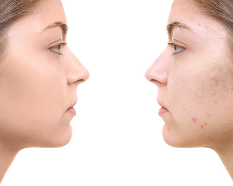 TCA Cross Acne Scars, Procedure & Treatment - Dr. Michele Green M.D.
