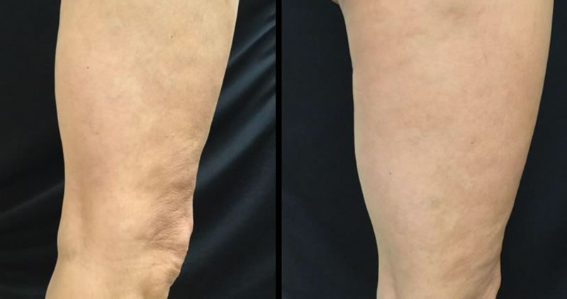 Before and After photo of Thermage procedure on Knee and thigh area (4 ...