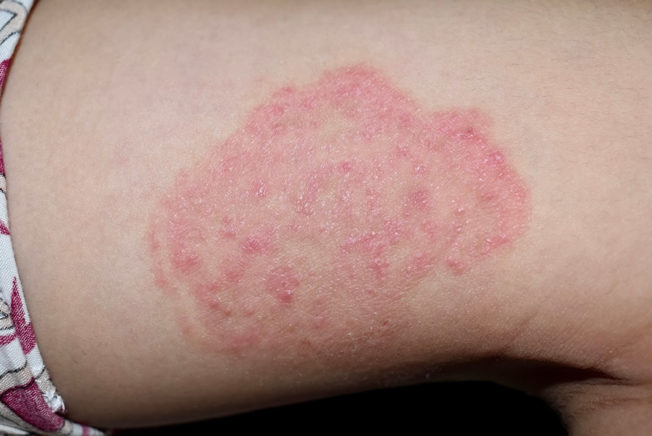 Types of Tinea (Capitis, Corporis, Cruris, Versicolor) - Dr. Michele ...