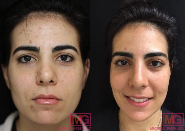 Clear + Brilliant vs. Fraxel - Dr. Michele Green M.D. NYC