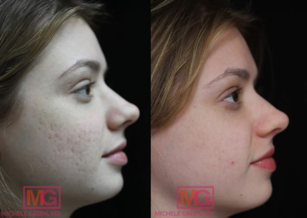VBeam Before & After Photos - Dr. Michele Green M.D.